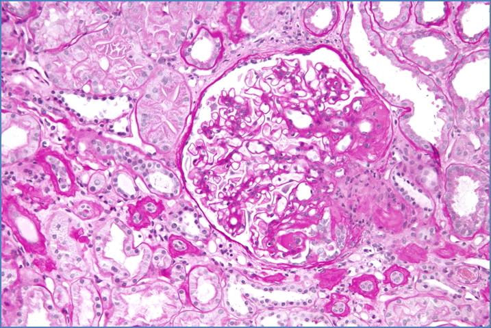 Focal Segmental Glomerulosclerosis | Renal | MedStudentNotes