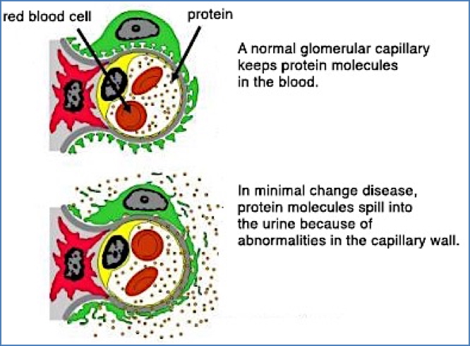 Minimal Change Disease | Renal | MedStudentNotes