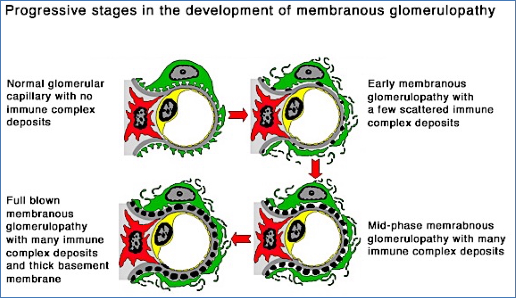 Membranous Nephropathy | Renal | MedStudentNotes