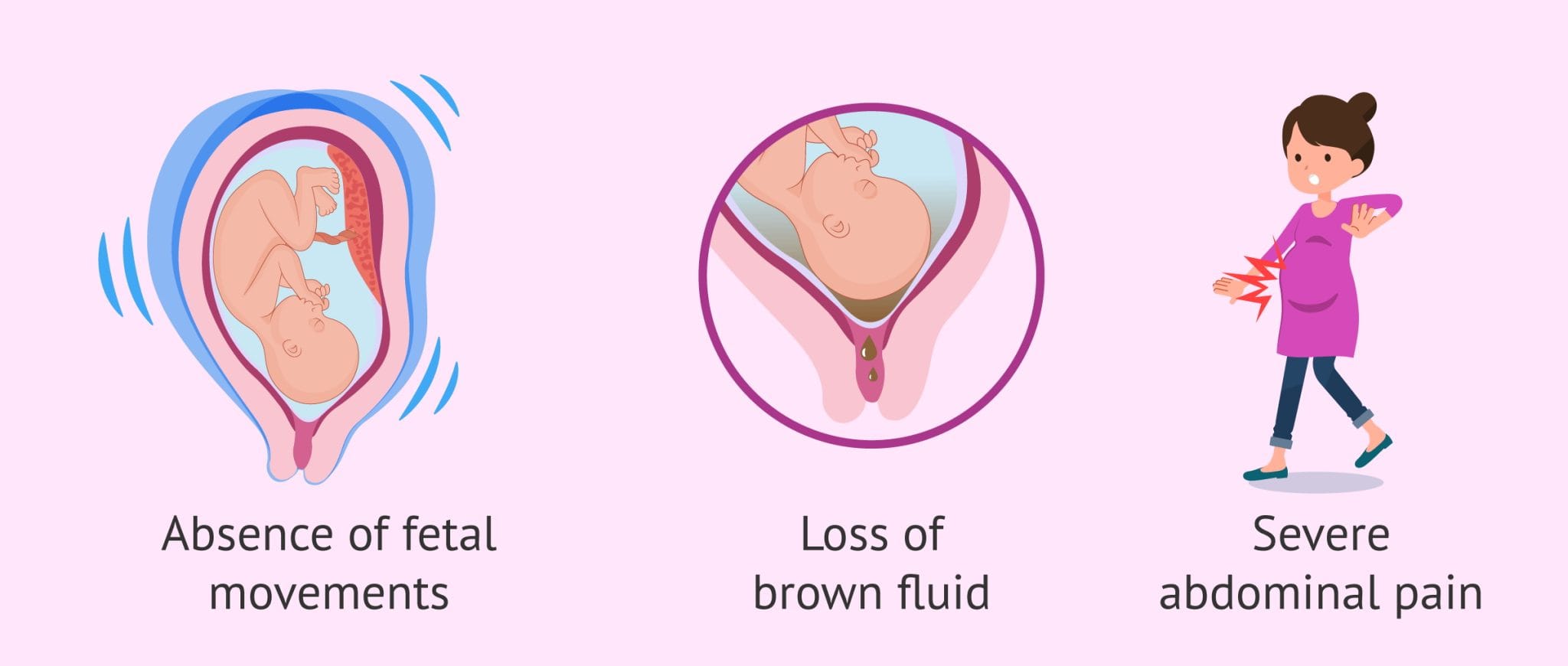 Intrauterine Foetal Death | Obstetrics | MedStudentNotes